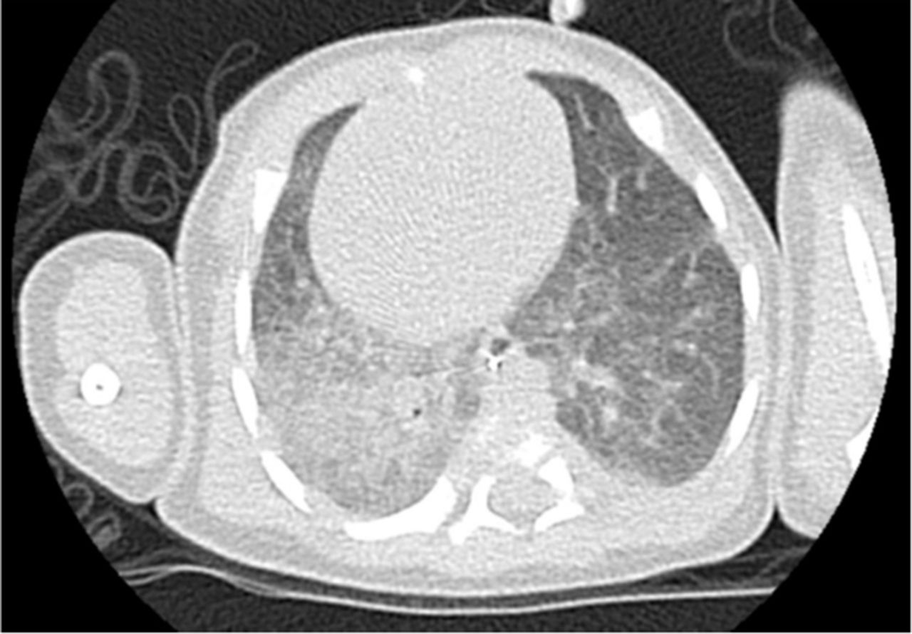 PP-090 Brain-lung-thyroid syndrome: neonatal phenotype of de-novo NKX2 ...