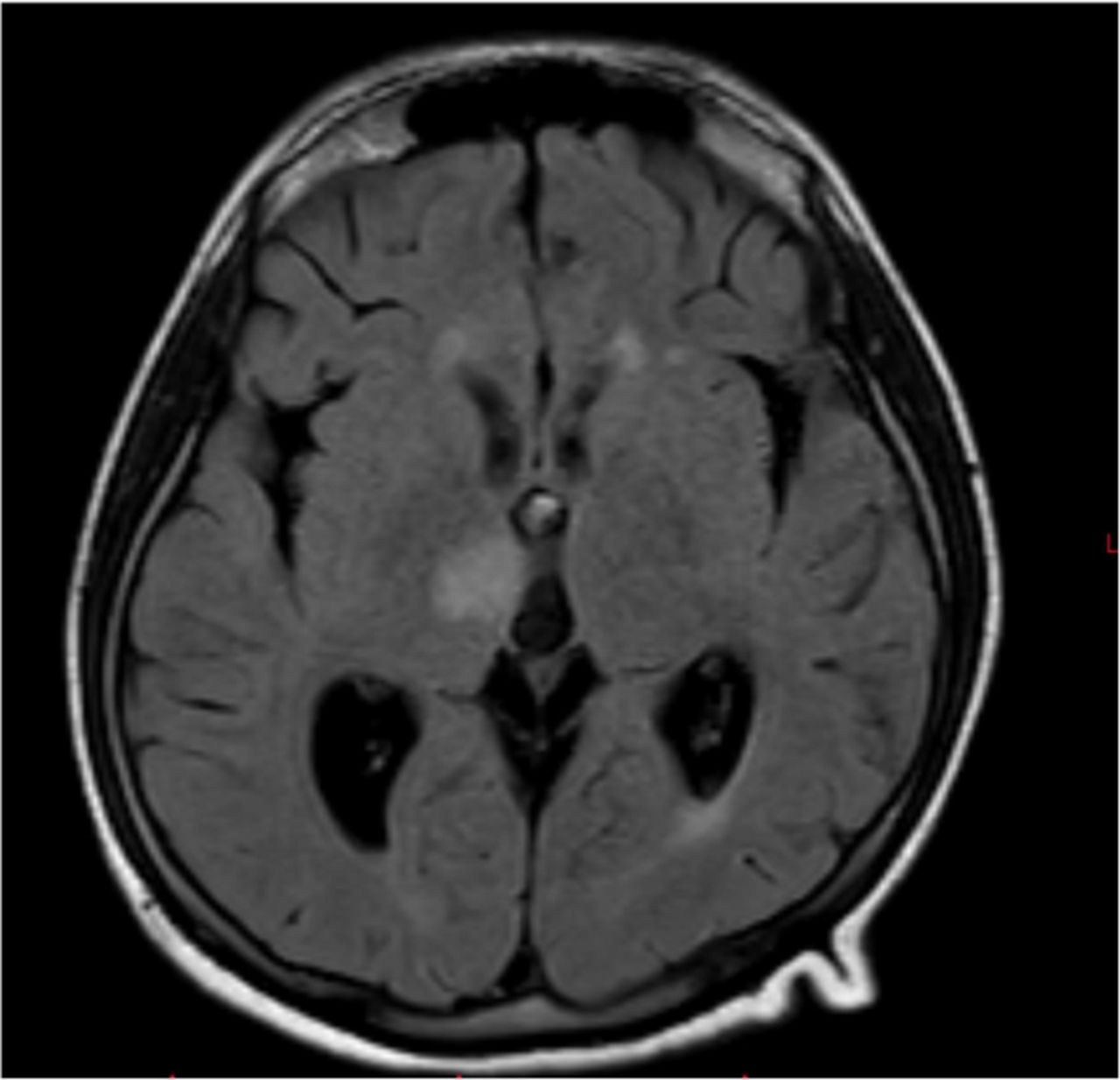OP-130 During treatment with methylprednisolone in a sixteen-year-old ...